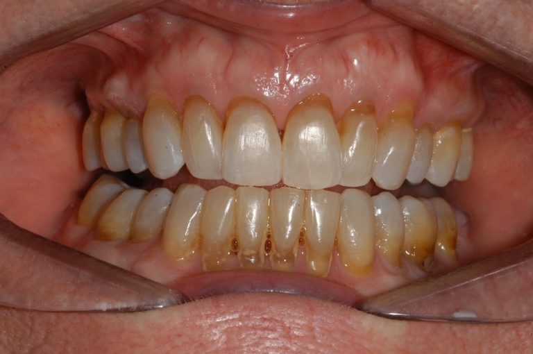 Receding Gums - Fox Dentistry Louisville
